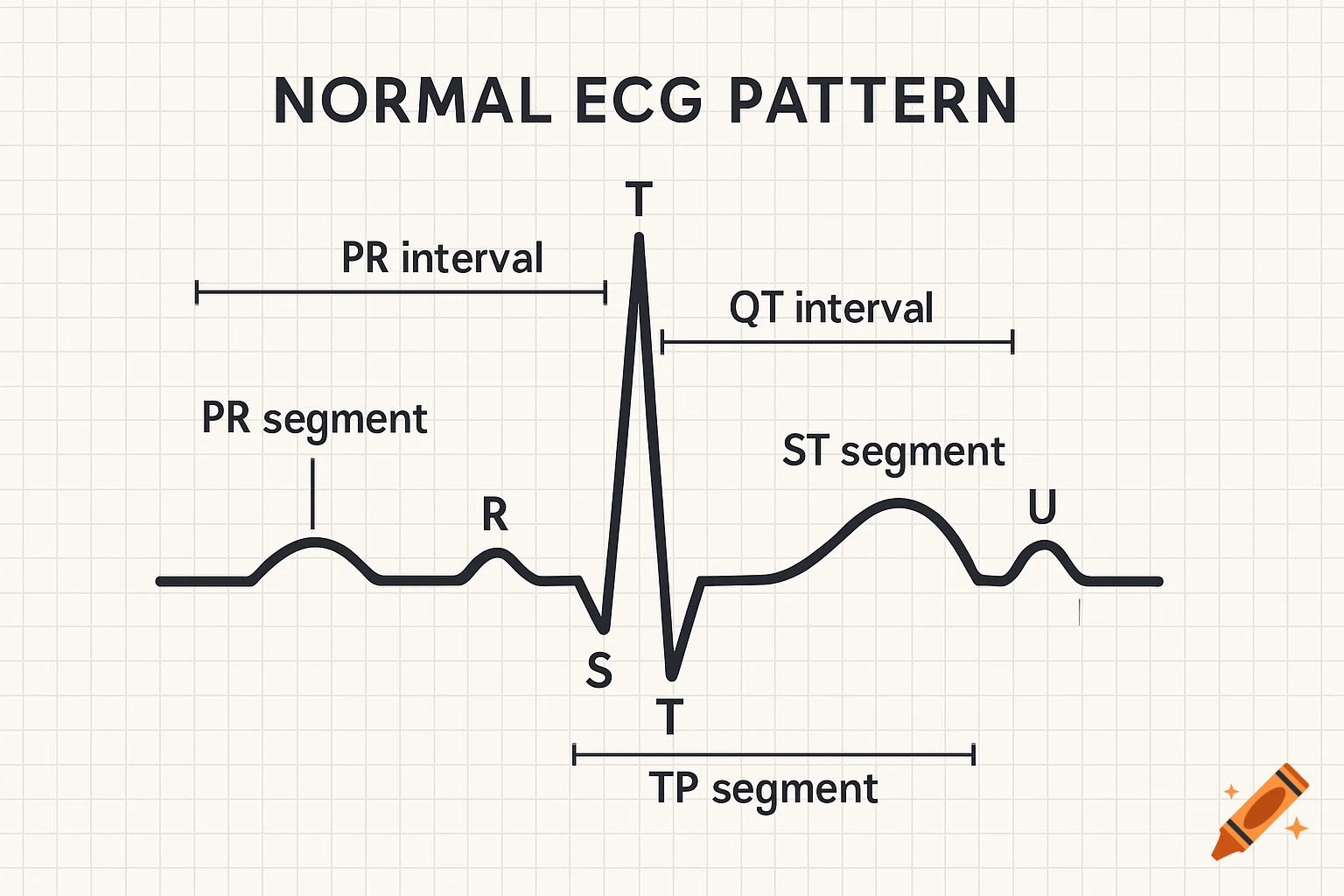 Diagram of a normal ECG pattern with labeled waves and intervals. on ...