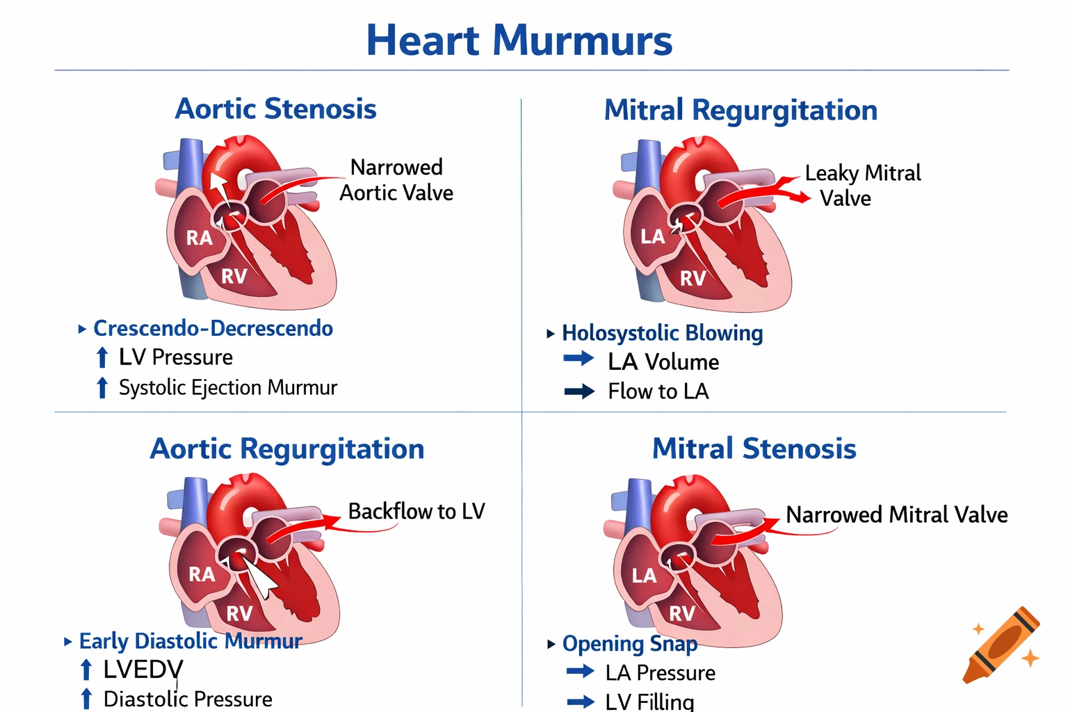 Medical diagram illustrating four types of heart murmurs: Aortic ...
